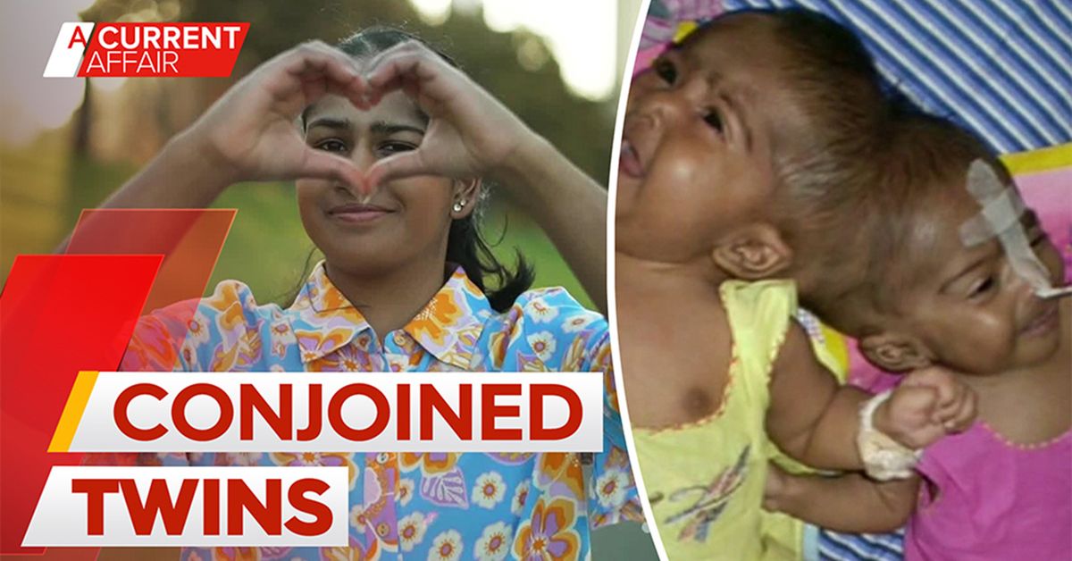 Conjoined twins separated in Melbourne 16 years ago living 'wonderful ...