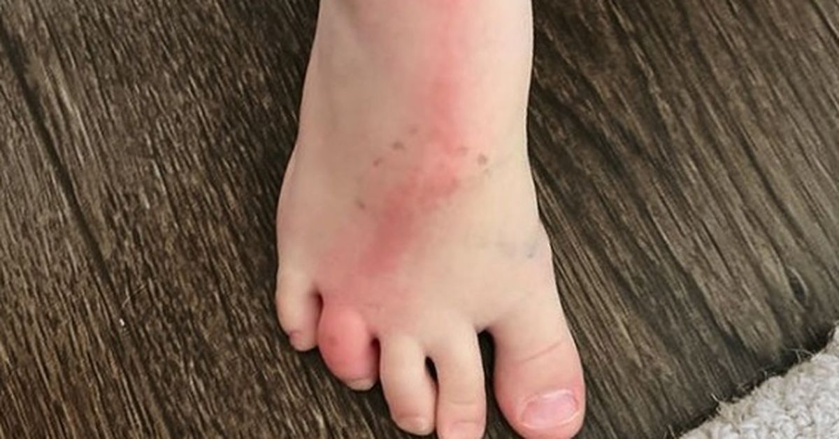 What does a red streak or red line on skin mean? Signs and symptoms of ...