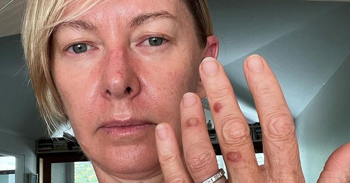 Deb Knight urges her followers to schedule their annual skin checks ...