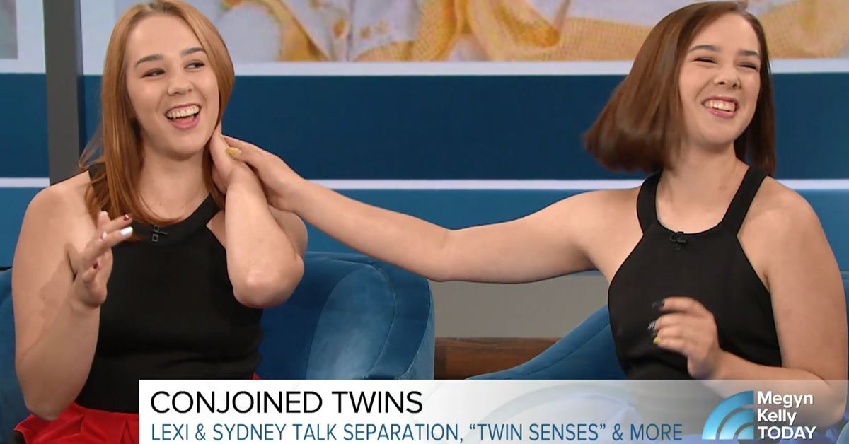 Conjoined twins Sydney and Lexi who survived risky surgery now thriving ...