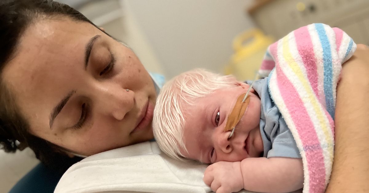 Baby Sarrinah was born at 26 weeks and has the rare condition albinism ...