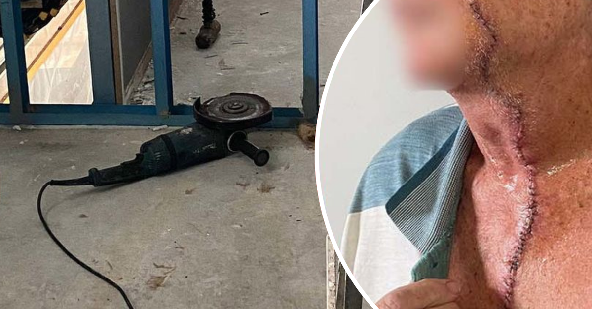 Darwin news: Man suffers gruesome injury using electric grinder at work