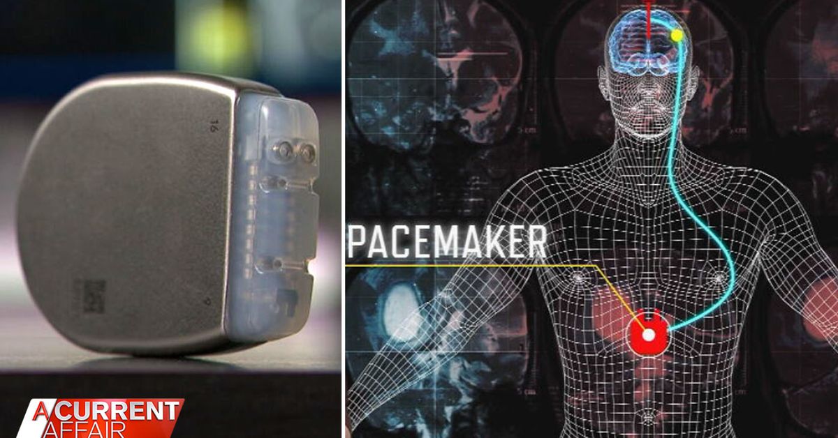 Medical study looks into treating OCD patients with pacemakers which ...