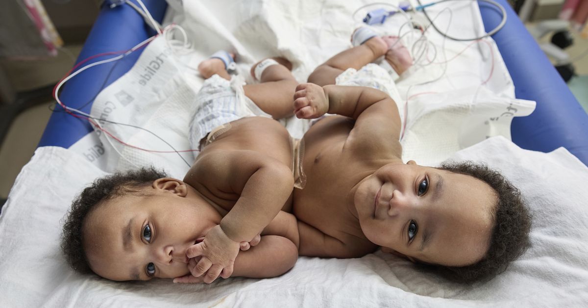 Twins born conjoined celebrate 1st birthday after separation surgery ...