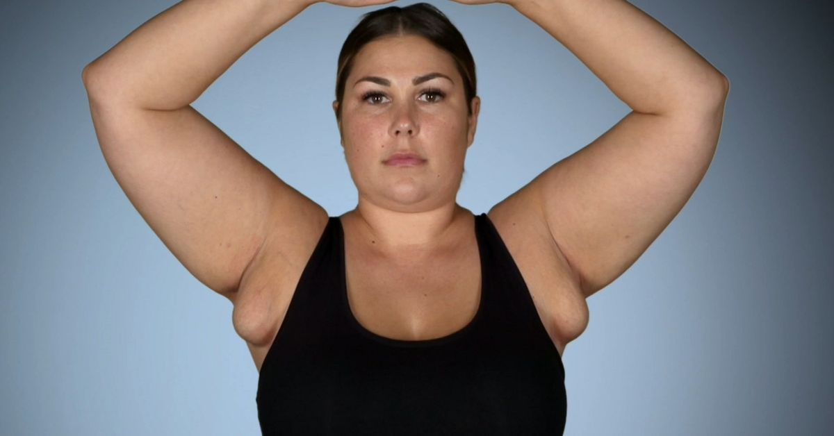 Botched: Woman with a second set of breasts in her armpits seeks help ...