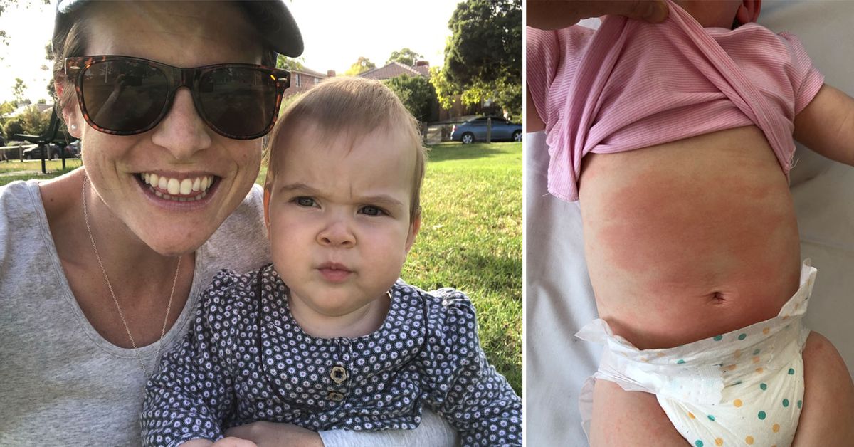 New Aussie study into food allergies a 'welcome relief' for parents ...