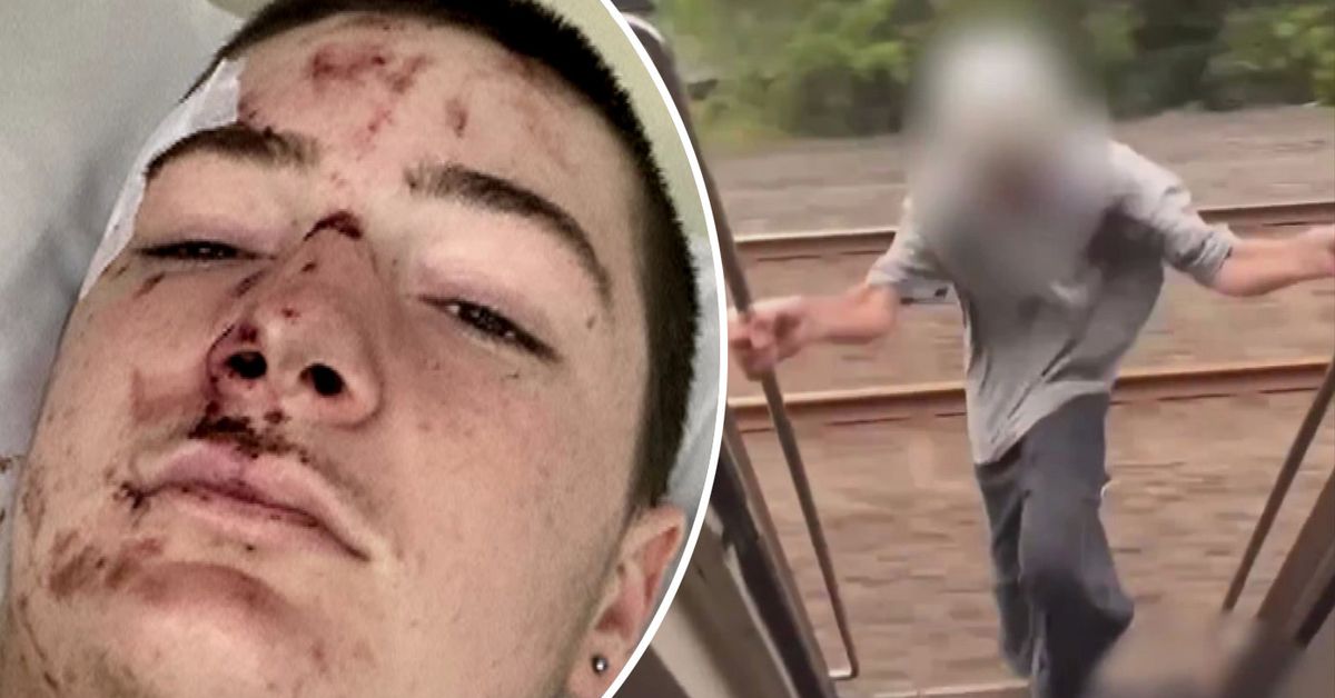 Buffer riding train trend: Sydney teen's warning after shattering legs ...