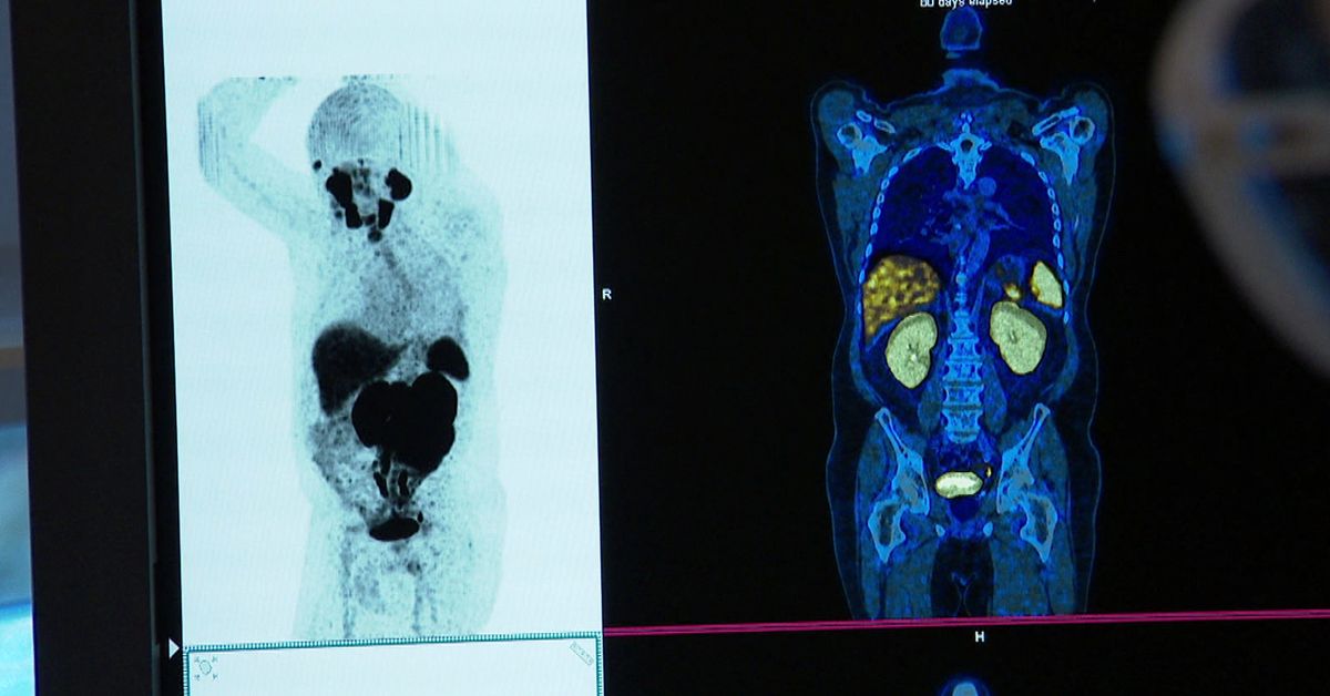 Health news: Drug trial offers prostate cancer patients new hope