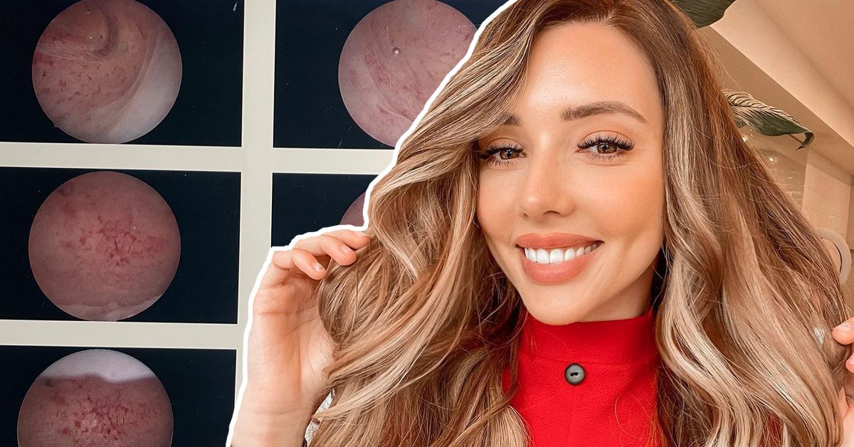 Erin Barnett endometriosis: Love Island star bled for four weeks ...