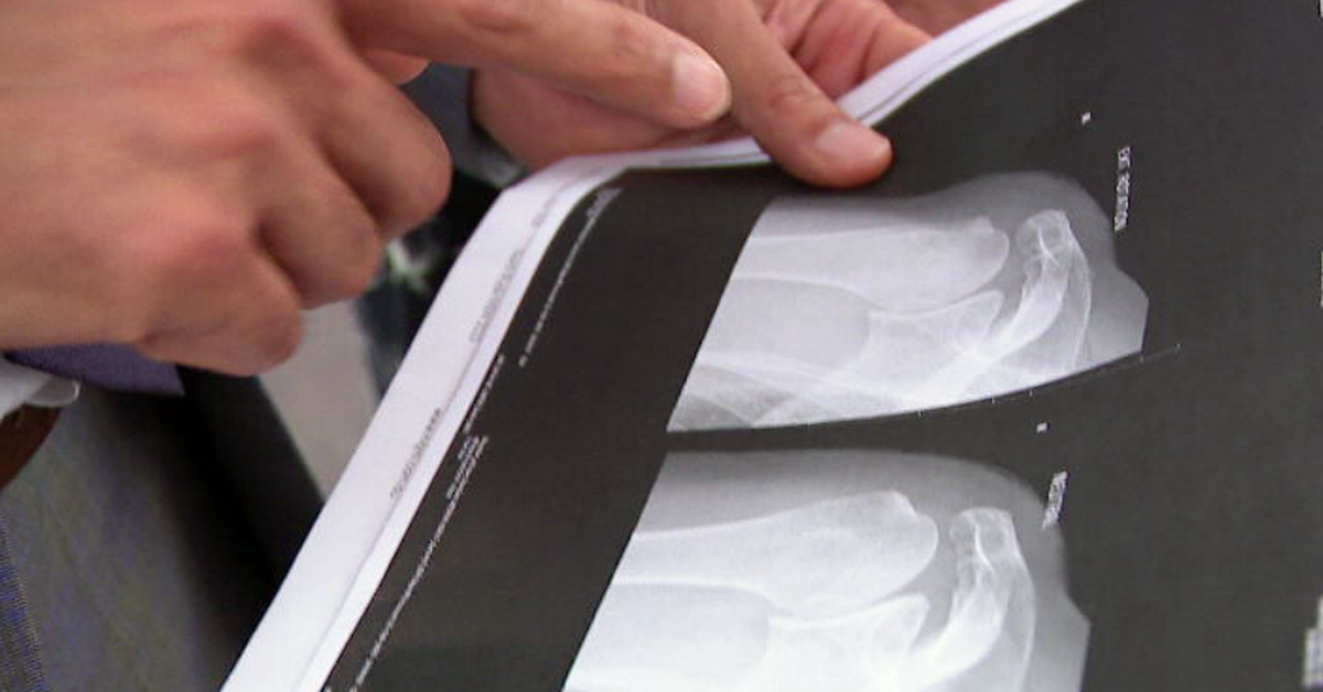 New treatment for 'excruciating' condition that is rising in numbers