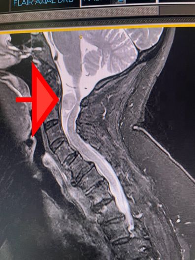 Spinal Meningioma: MRI revealed Queensland woman Deborah Nutter had a ...