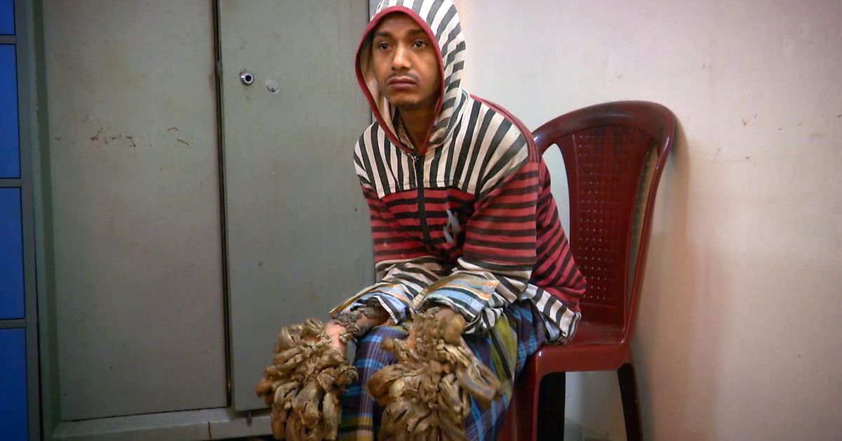Body Bizarre: Meet 'Tree Man', the young man with branch-like limbs ...
