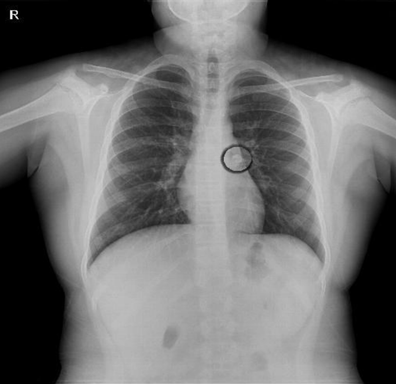 Loose tooth found in the lung of a 9-year-old after she inhaled it in ...