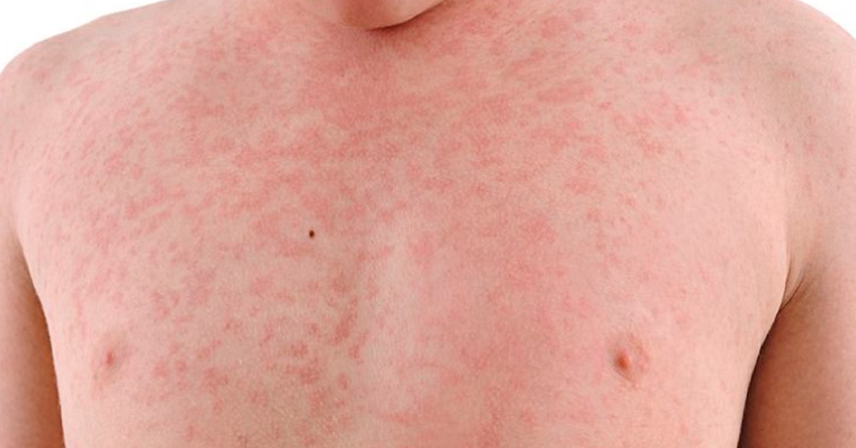 Melbourne: Measles outbreak sparks health warning across Victoria