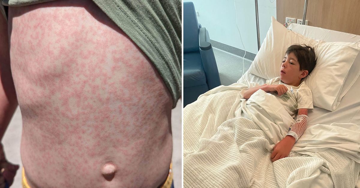 Kawasaki Disease in children: Sydney mum's warning after son's fever ...